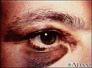 Bleeding into the skin