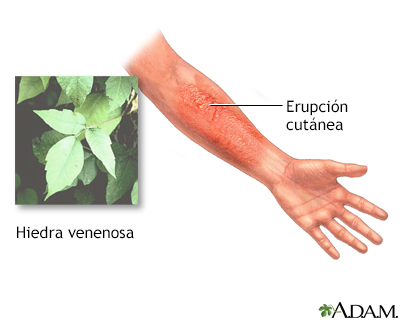 Erupción cutánea por hiedra, roble o zumaque venenosos